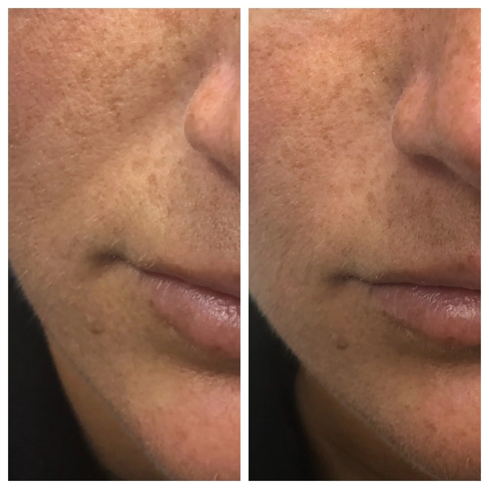 MidFace — A Fine Line Aesthetics