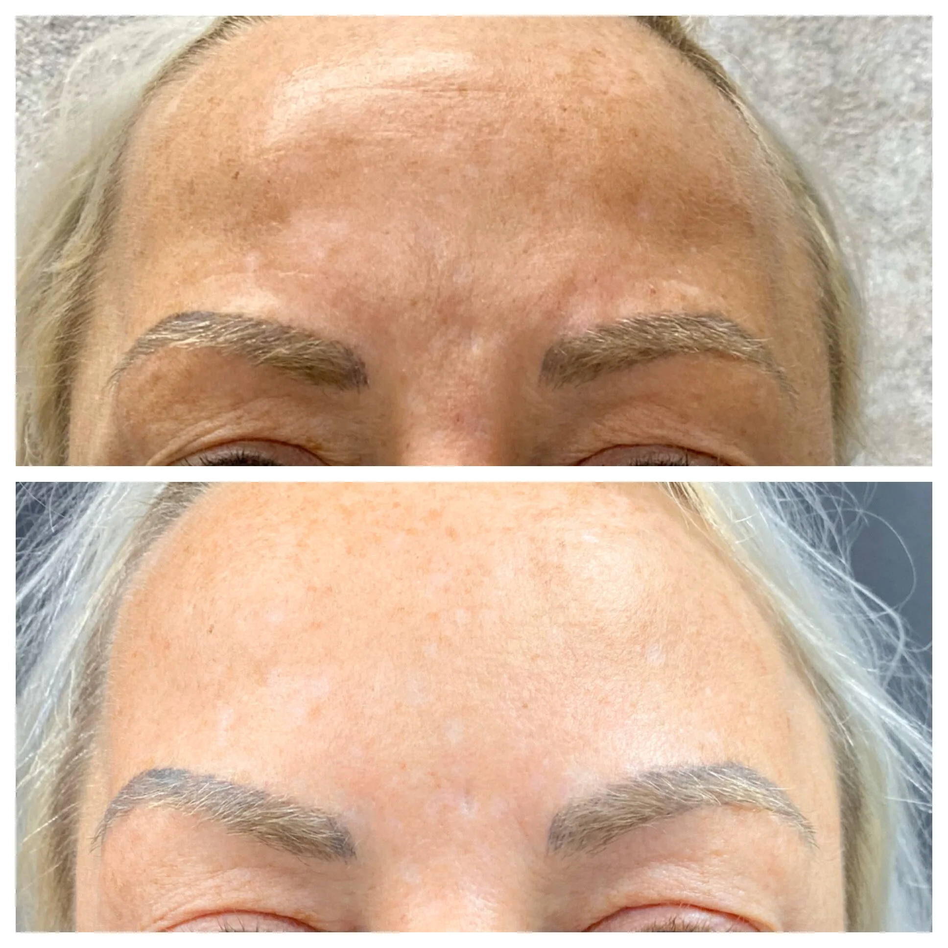 Tox (Botox / Jeuveau) — A Fine Line Aesthetics