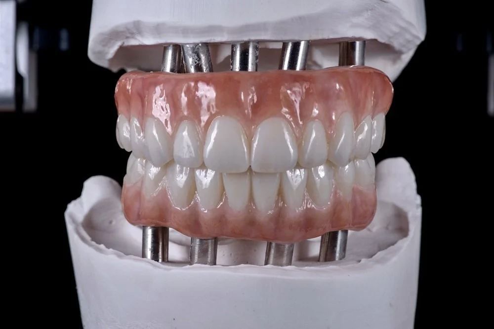 Implant-Denture Hybrid Dental Solutions — Shikosha Dental Laboratory
