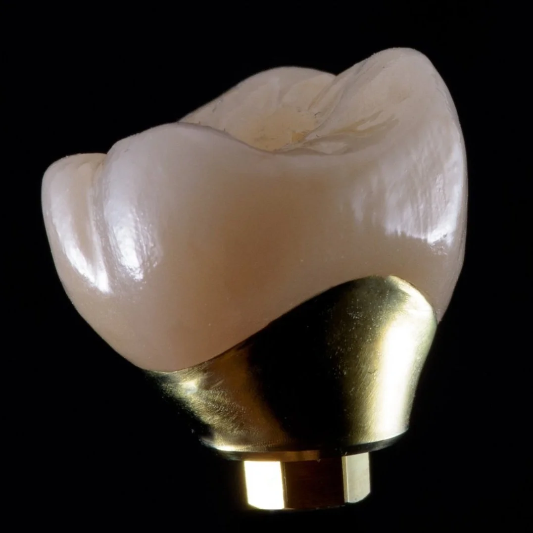 Implant-Denture Hybrid Dental Solutions — Shikosha Dental Laboratory