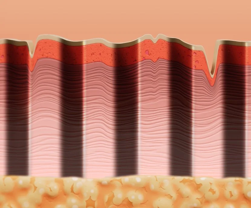 Ellacor Loose Skin Treatment in Houston : Premier Derm Center