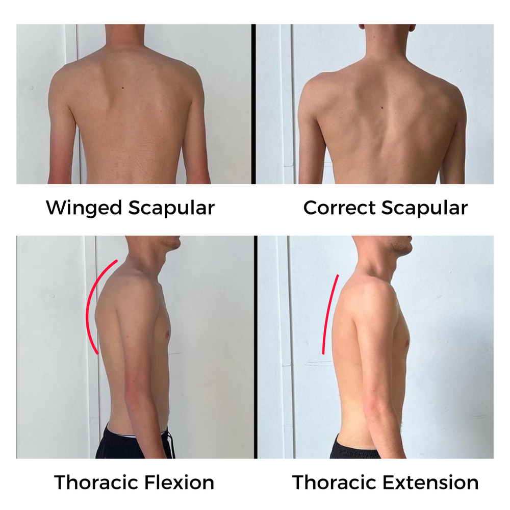 Correct Winged Scapulas — Functional Patterns Brisbane