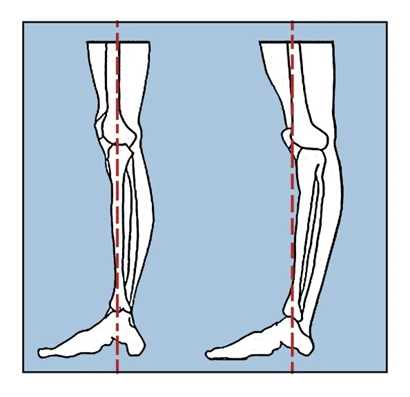 Exercises For Hyperextended Knees: A Guide To Strength — Functional ...