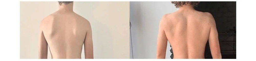 Correct Winged Scapulas — Functional Patterns Brisbane