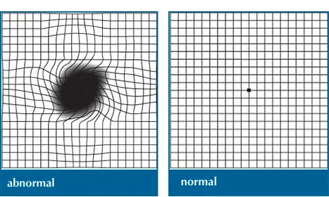 Macular Degeneration — Eye Surgery Associates | Auckland
