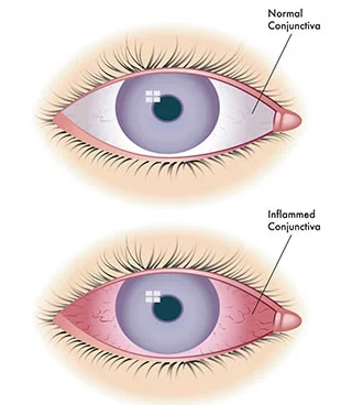 Uveitis — Eye Surgery Associates | Auckland