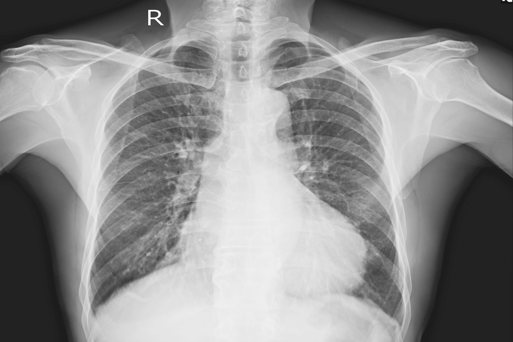 Respiratory Distress Syndrome X Ray