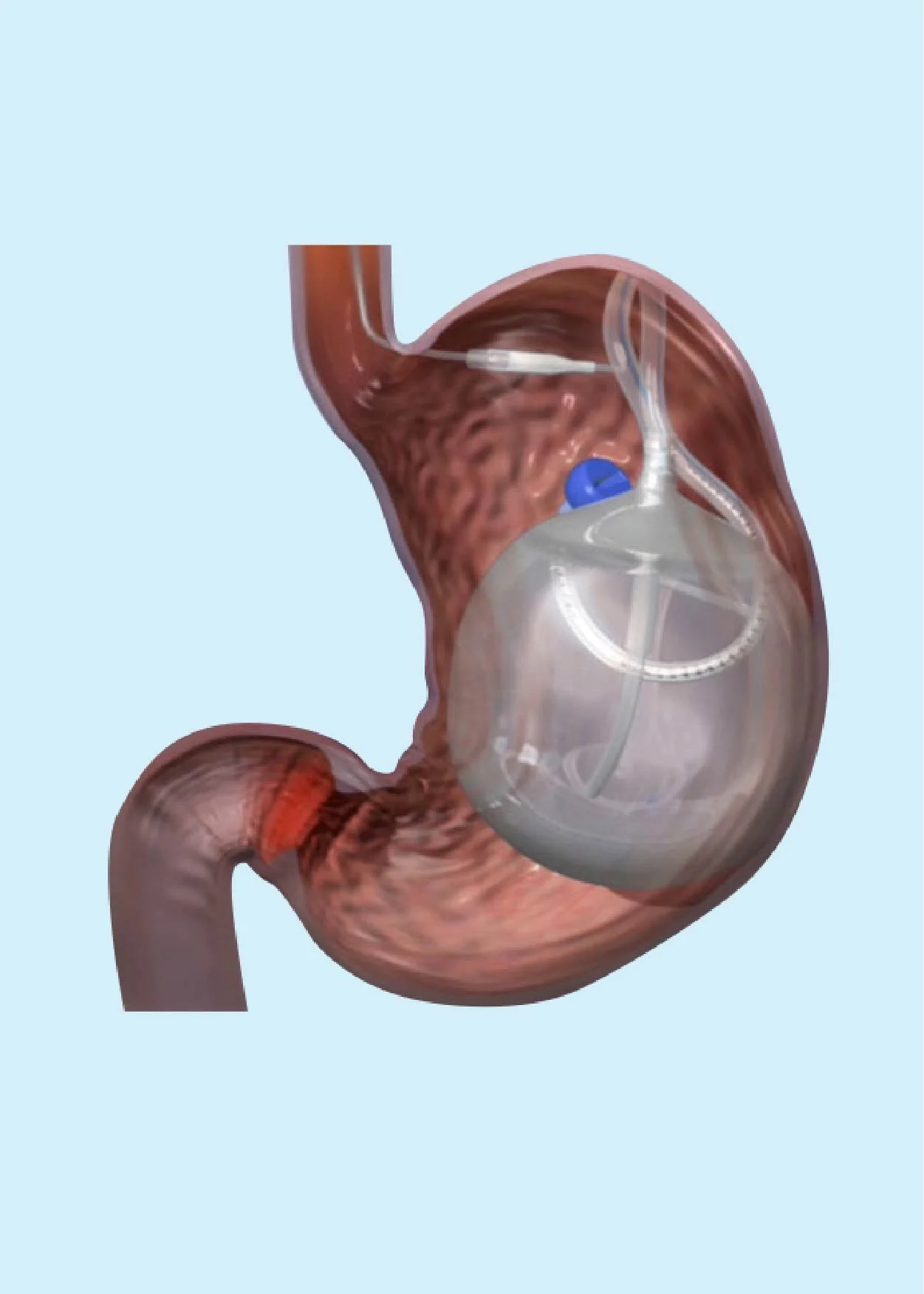 Procedimientos Endoscópicos — Obesium