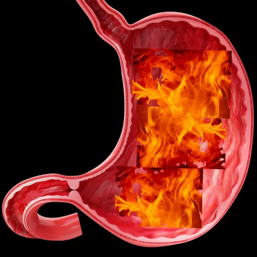 Gastroesophageal Reflux Disease Presents Differently in Women and Men ...