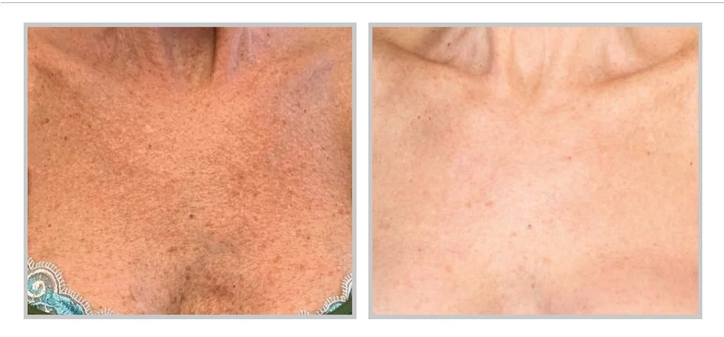 Sciton BBL Hero — Farashe Med & Day Spa