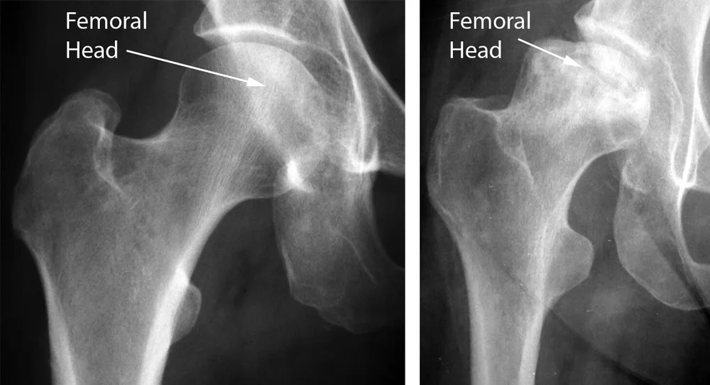 avascular necrosis — Gormack Orthopaedics