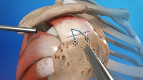 rotator cuff surgery — Gormack Orthopaedics