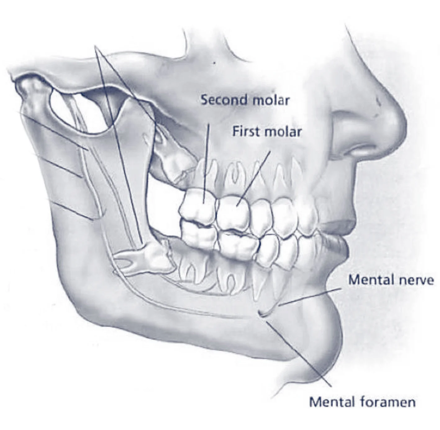 Upper Wisdom Tooth Extraction