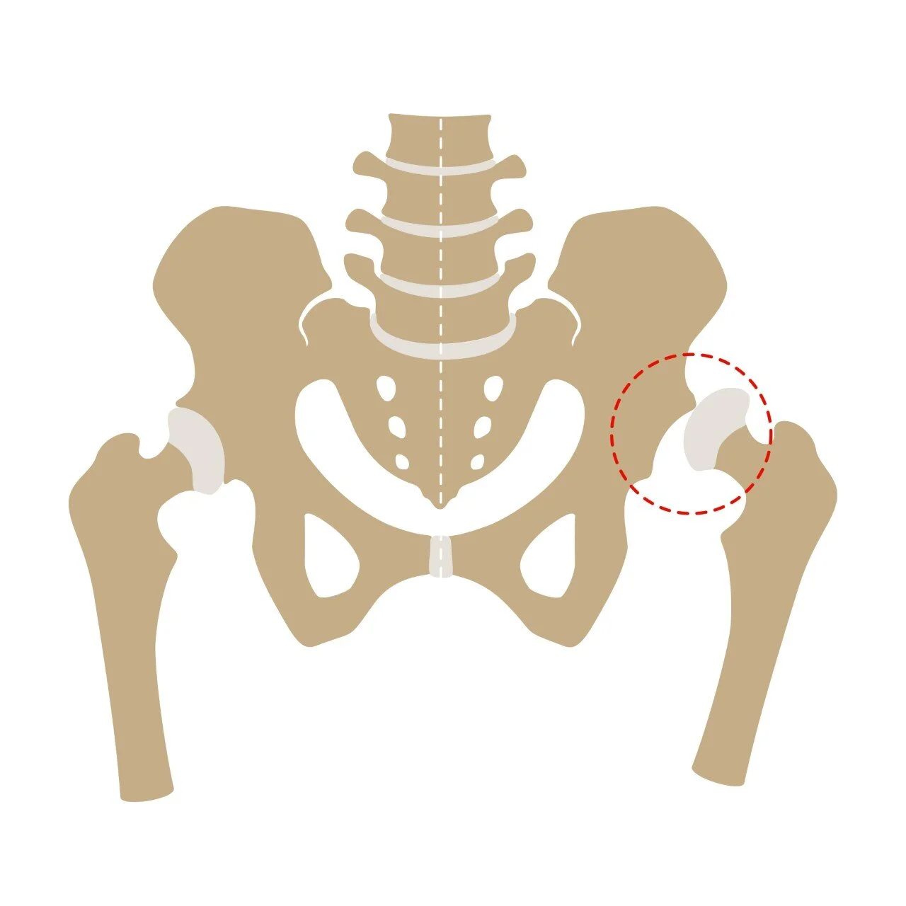 Fundamentals Paediatric Physiotherapy Developmental Dysplasia of the ...