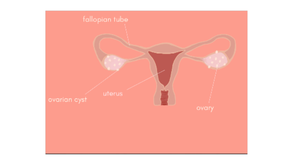 What is PCOS? Symptoms & Support Information QENDO