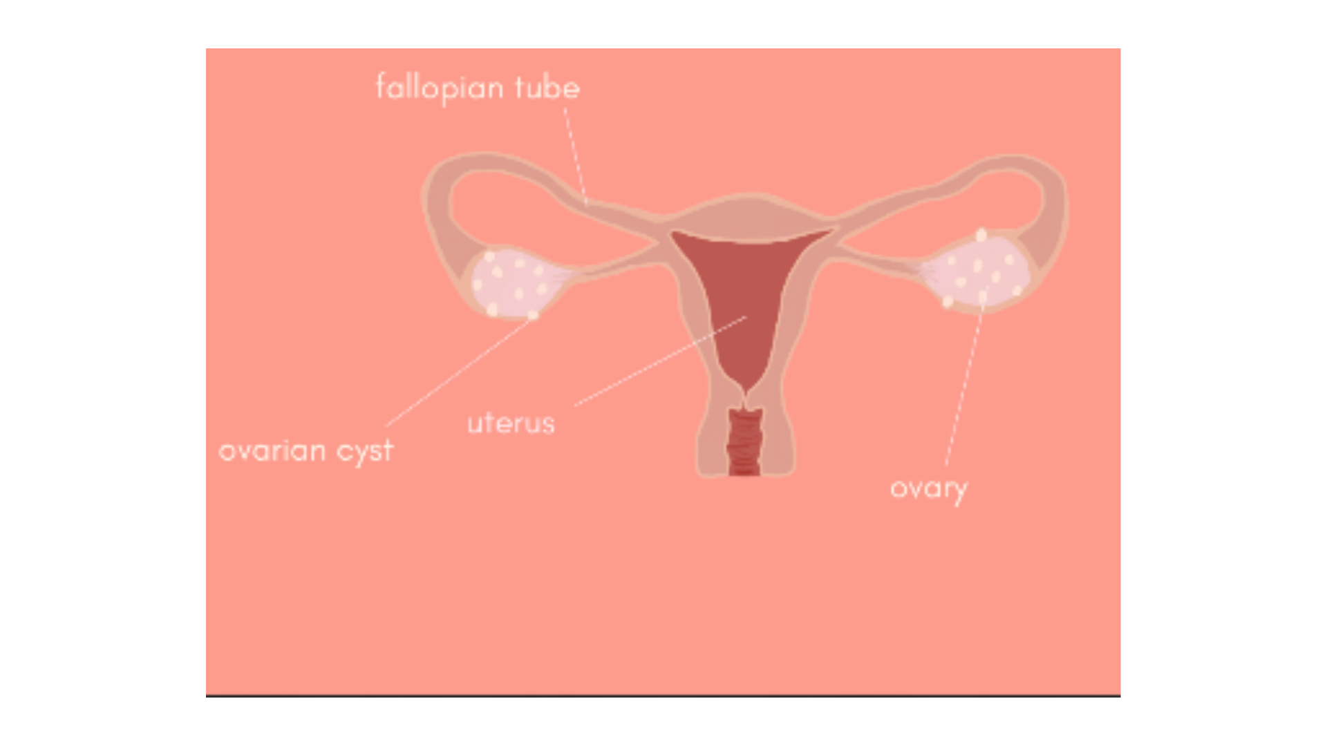 What is PCOS? Symptoms & Support Information QENDO