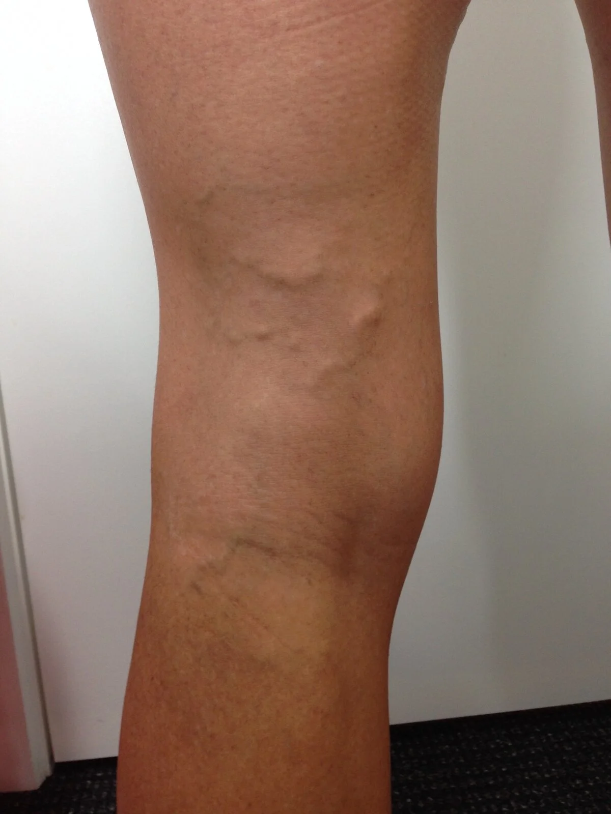 Varicose Vein Results and post treatment photos. — The Leg Vein Doctor ...