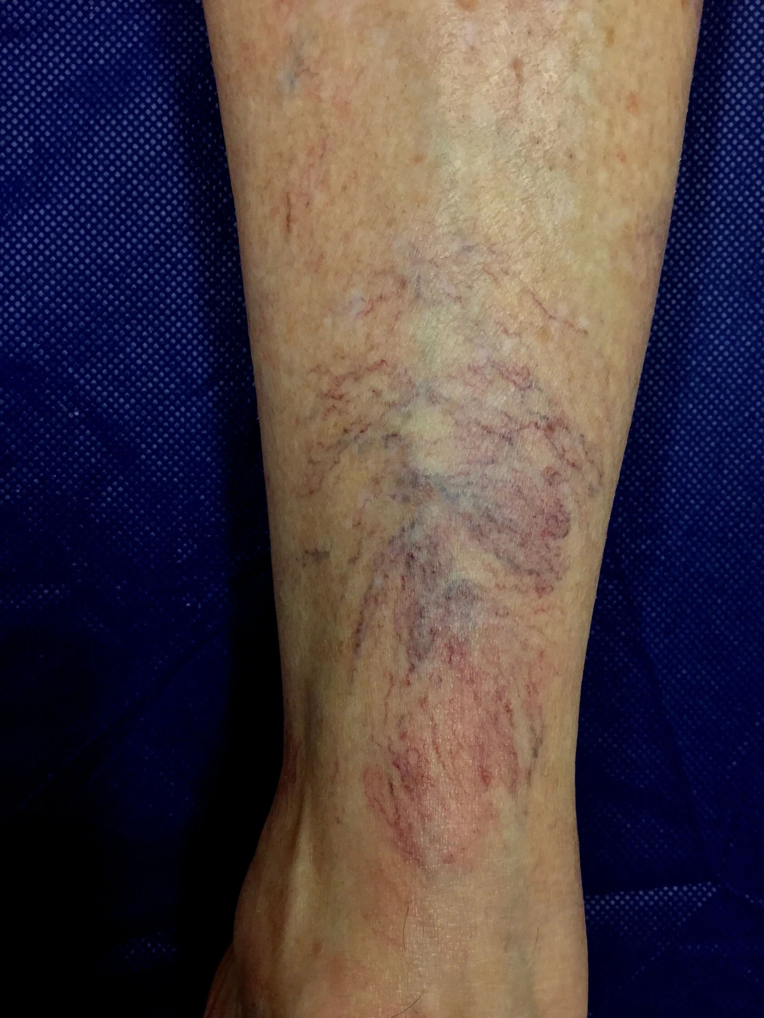 Spider Vein Treatment Brisbane Results — The Leg Vein Doctor | Brisbane ...