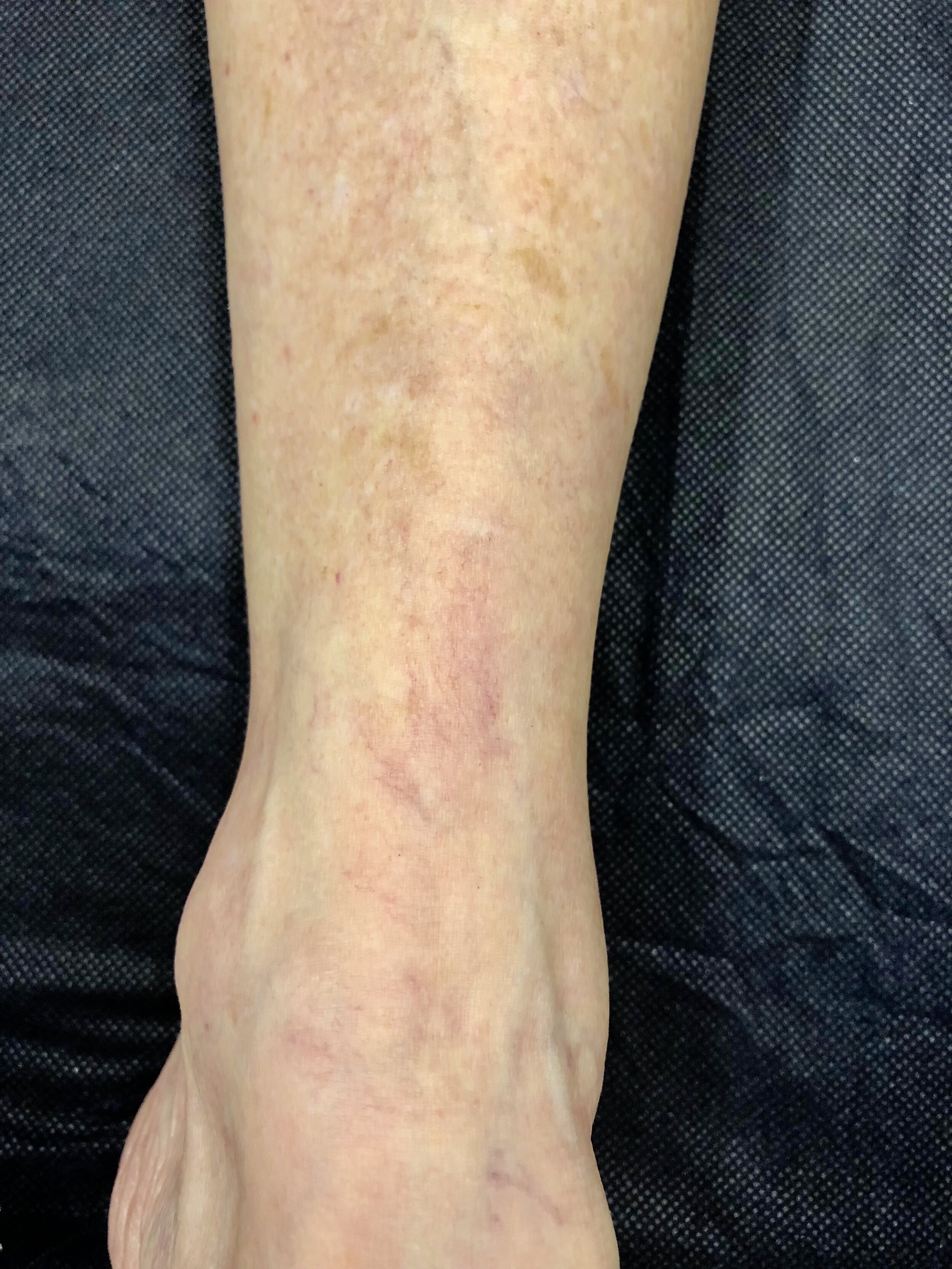 Spider Vein Treatment Brisbane Results — The Leg Vein Doctor | Brisbane ...