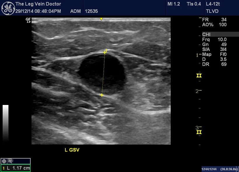 Endovenous Laser Therapy — The Leg Vein Doctor | Brisbane | Varicose ...