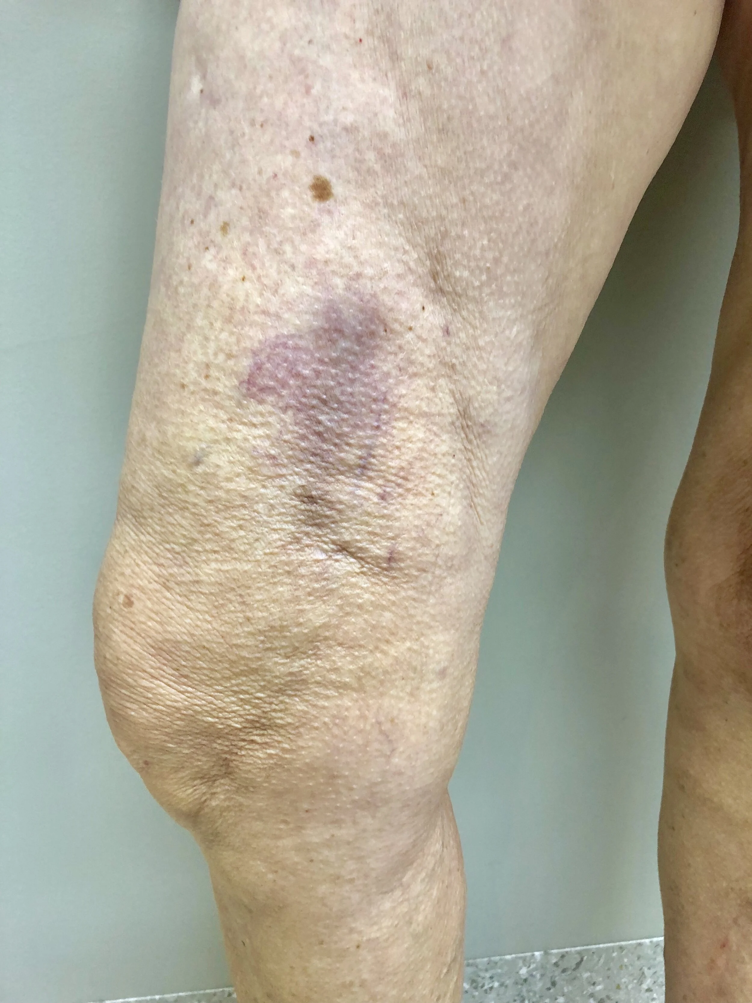 Varicose Vein Results and post treatment photos. — The Leg Vein Doctor ...