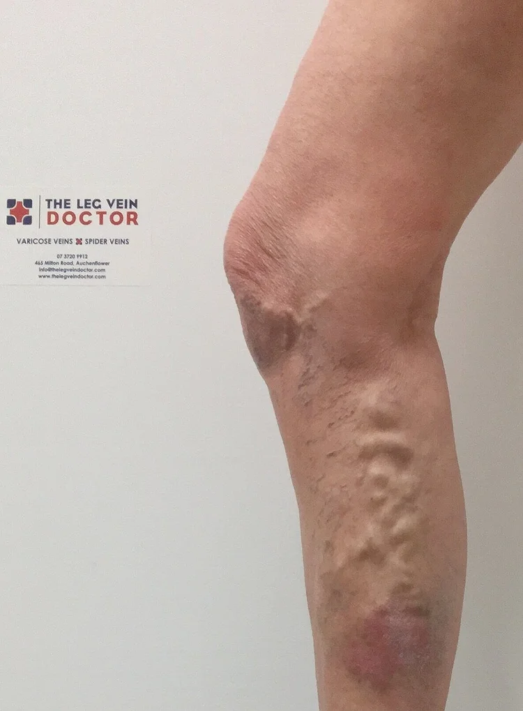 What Causes Varicose Veins? — The Leg Vein Doctor | Brisbane | Varicose ...