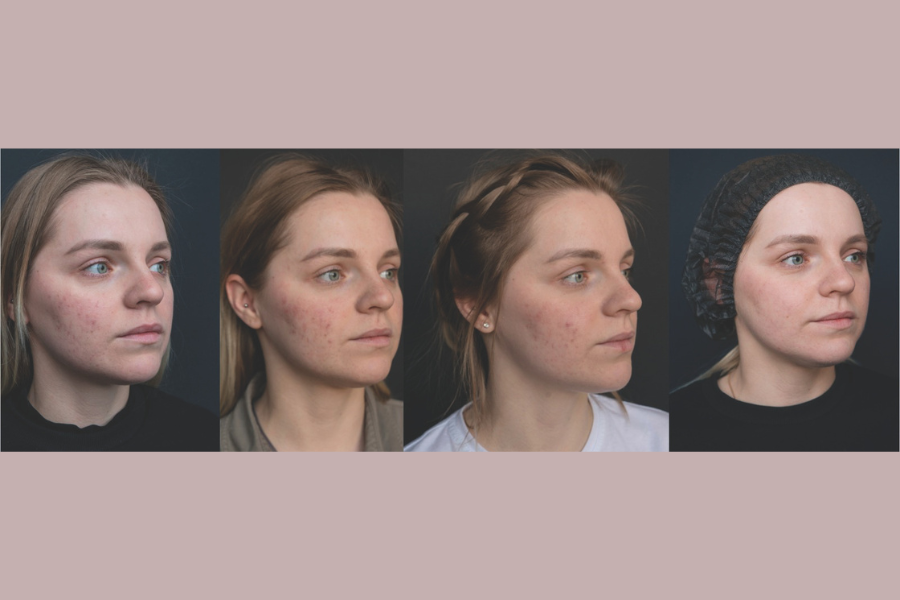 6 Reasons Why the PlaDuo is the Perfect Add-On to Your Clinic’s ...