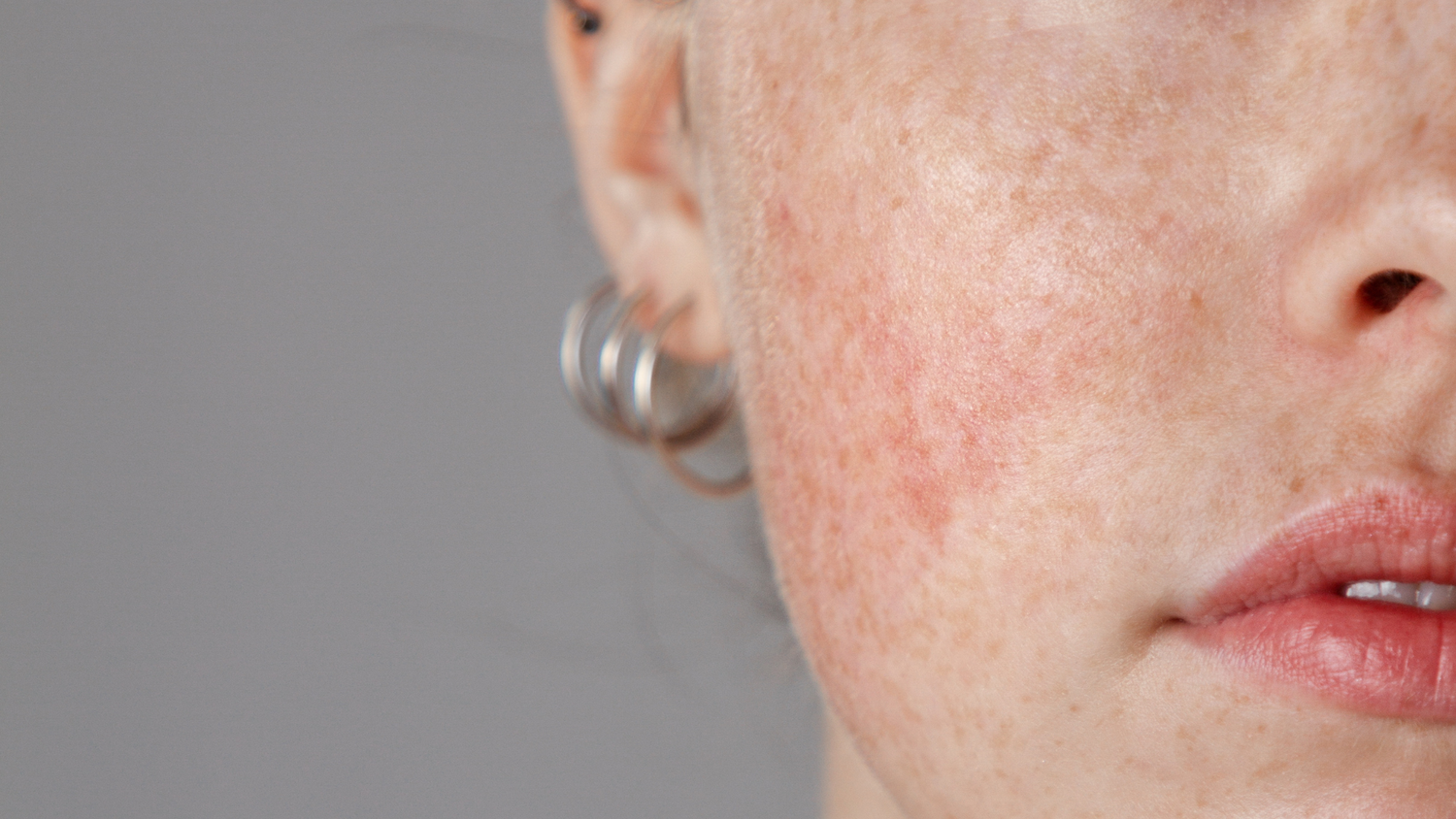 Treating Rosacea With Laser — PBL Magazine