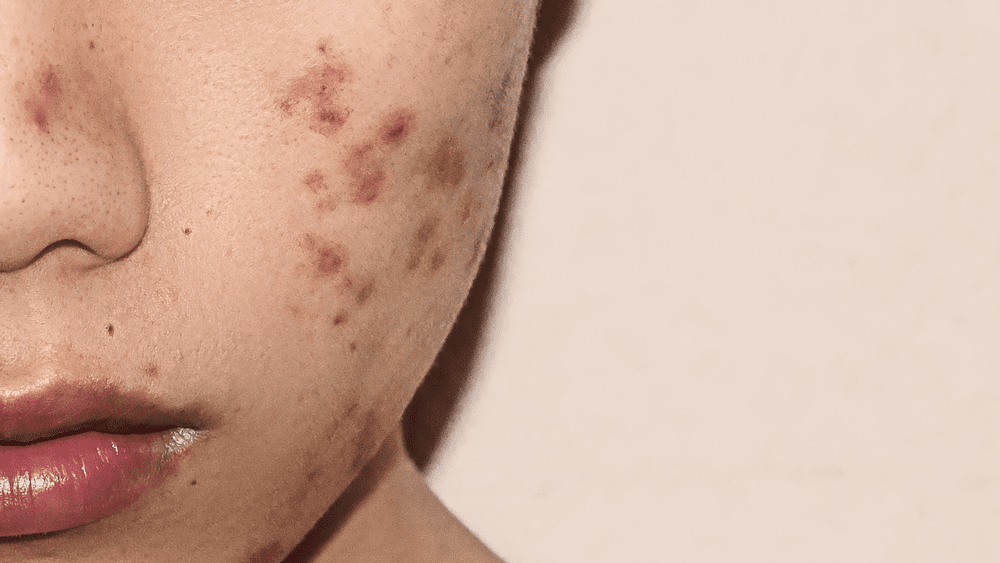 How To Manage Post Acne Pigmentation — PBL Magazine