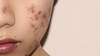 How To Manage Post Acne Pigmentation — PBL Magazine