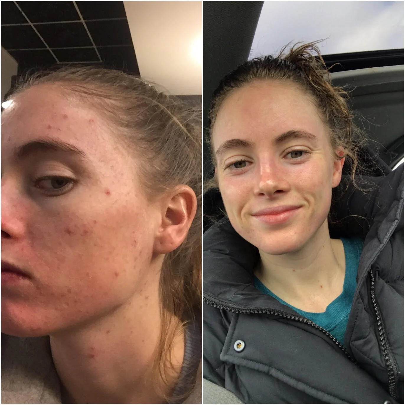 Caralyn is a personal skin coach and acne expert, offering a holistic ...