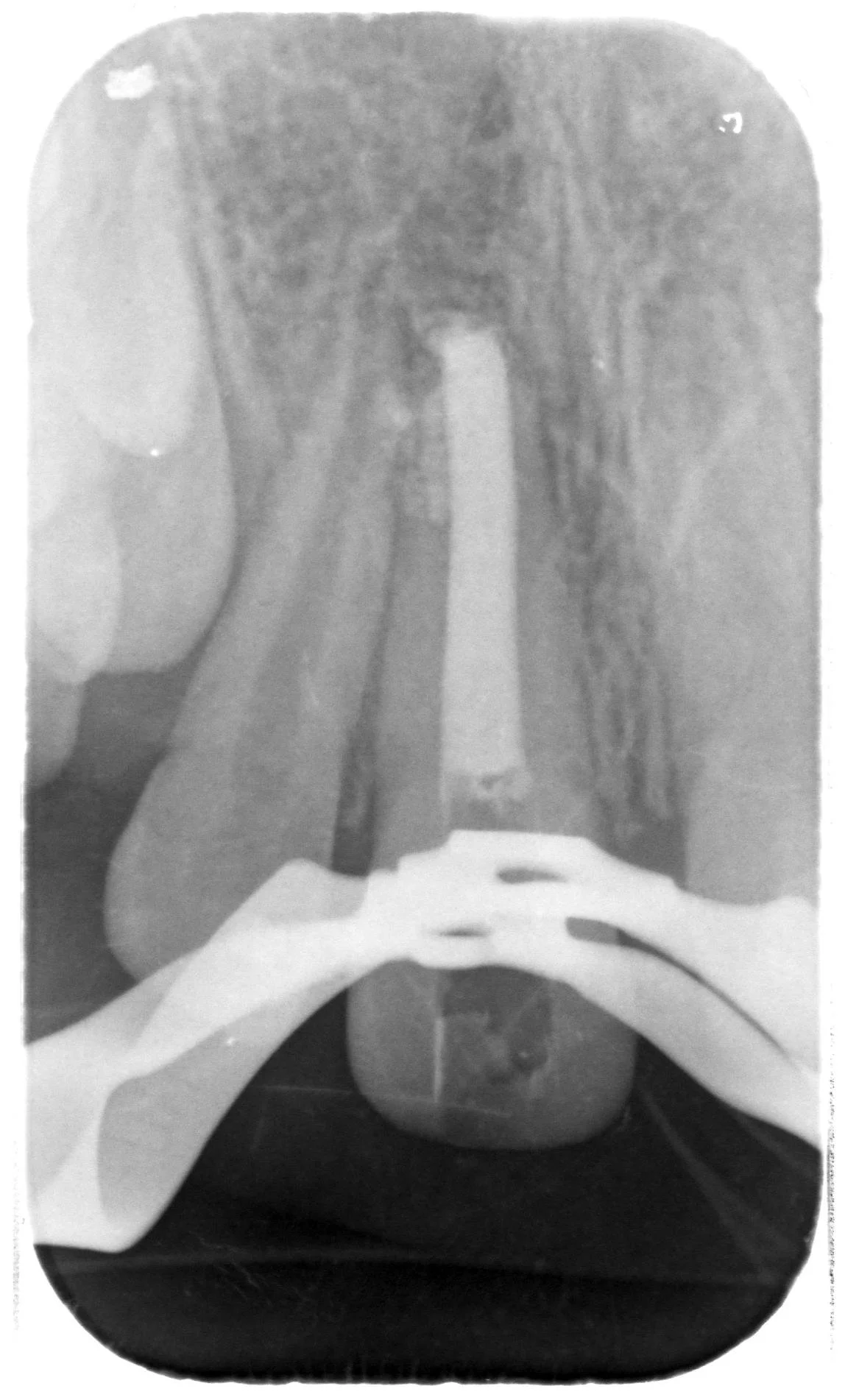 How to Manage a Dead Permanent Anterior Tooth - Thinking Long-Term ...