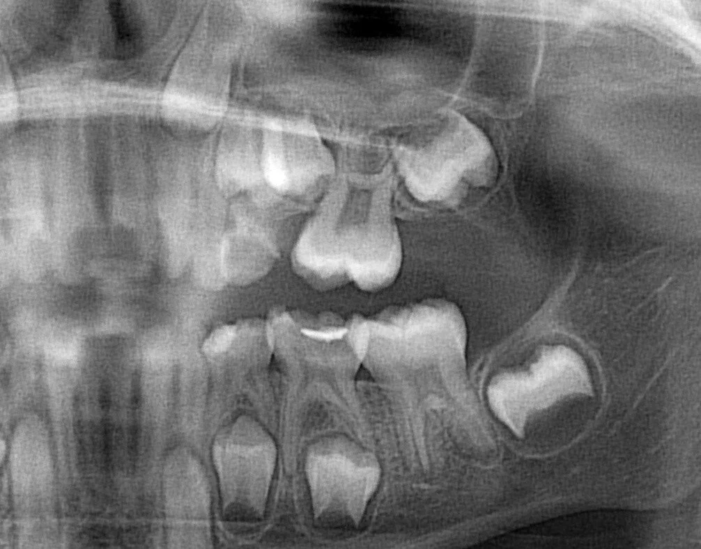Why Should We Treat Primary Teeth With Dental Caries? — Kids Dental Tips
