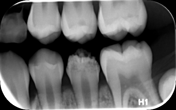 Why Should We Treat Primary Teeth With Dental Caries? — Kids Dental Tips