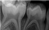 Hall Crowns: A Simple Non-Invasive Restorative Technique that is Highly ...
