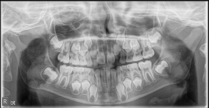 Part 3: When to Use (and When to Skip) OPGs in Paediatric Dentistry ...