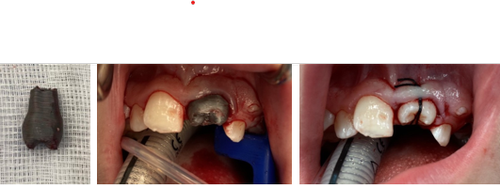 Anterior Tooth Autotransplantation — Kids Dental Tips