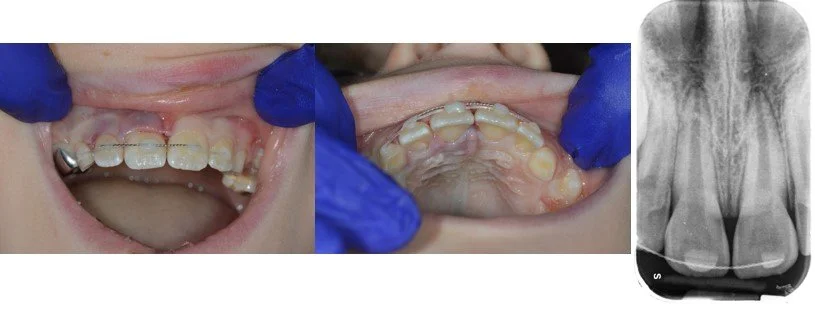 How to Reposition a Luxated (Displaced) Permanent Tooth — Kids Dental Tips