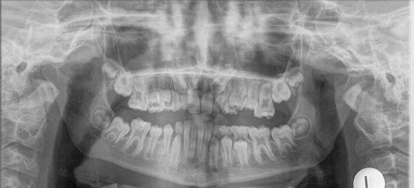 Orthodontic Considerations for Interceptive Extraction of First Molars ...