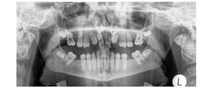 Orthodontic Considerations for Interceptive Extraction of First Molars ...