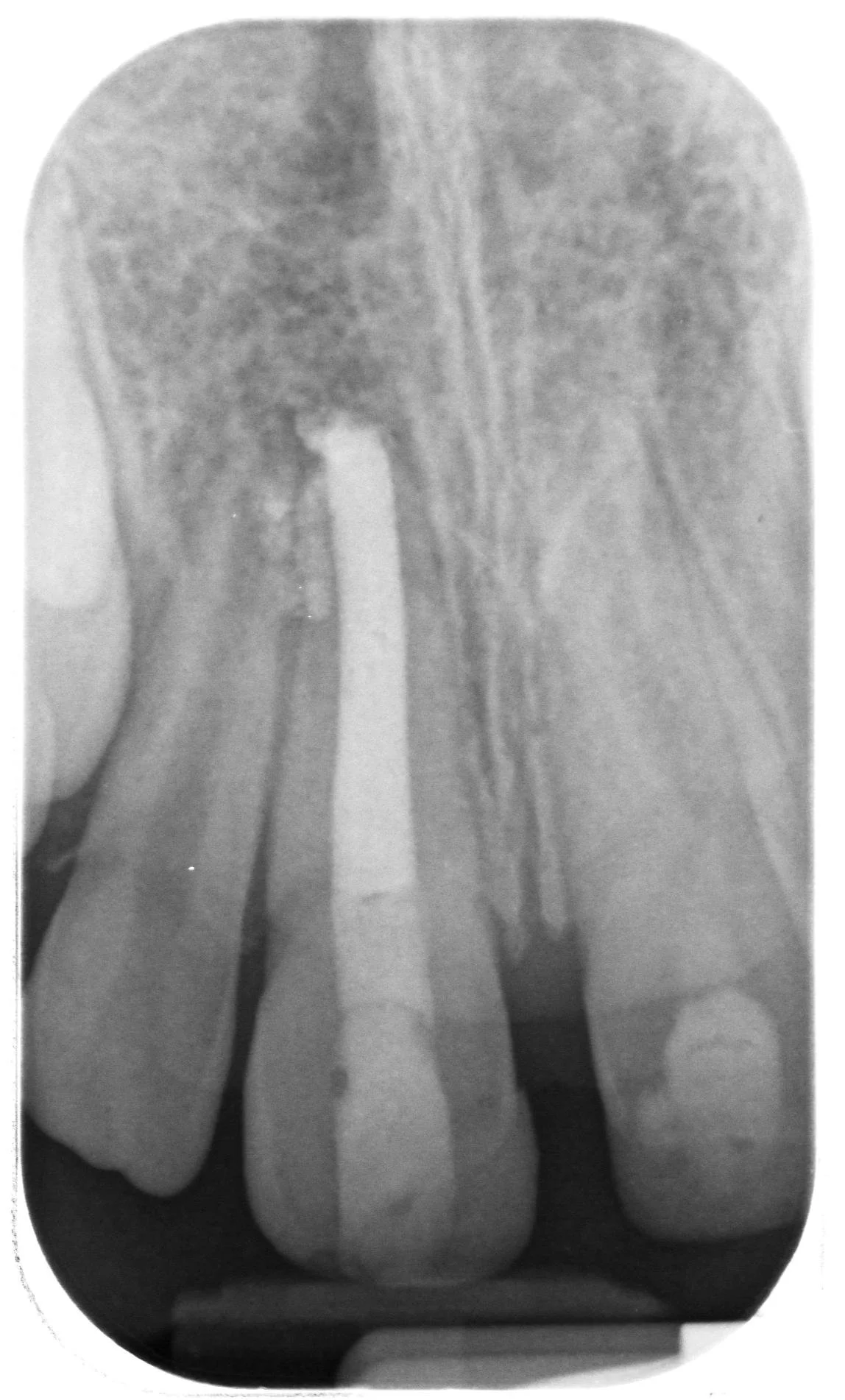How to Manage a Dead Permanent Anterior Tooth - Thinking Long-Term ...
