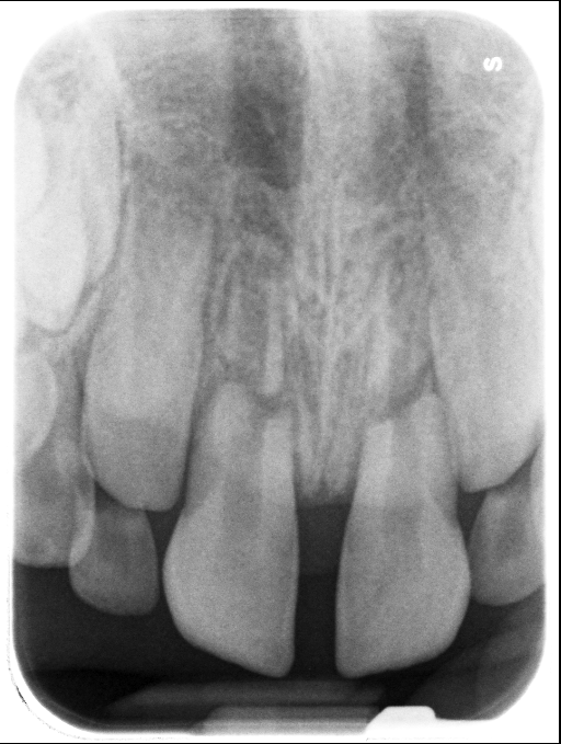 Hopeless Prognosis? Root fracture in the immature permanent dentition ...
