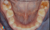 Is Toothmousse all it’s cracked up to be for Hypomineralisation? — Kids ...