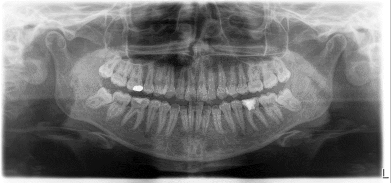 Orthodontic Considerations for Interceptive Extraction of First Molars ...