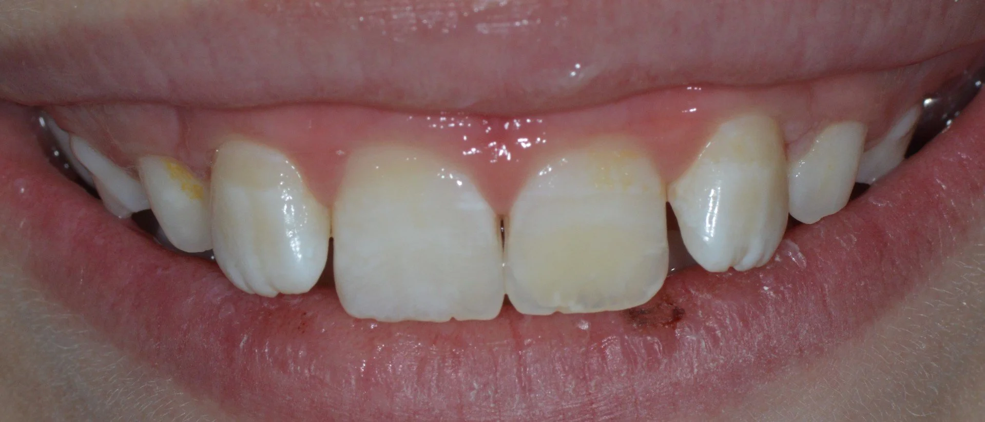 Anterior Hypomineralisation - How To Improve The Aesthetics — Kids ...