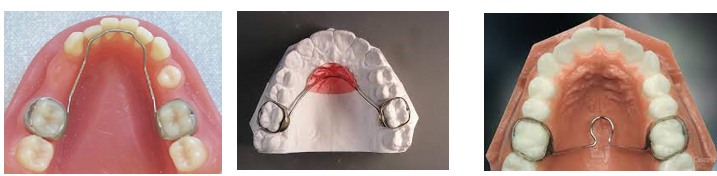 Space Maintainers Part 2 - Which one to use, When and How — Kids Dental ...