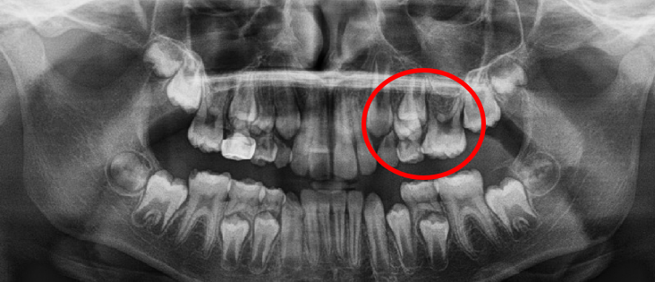 Space Maintainers Part 1 - When to Maintain Space — Kids Dental Tips