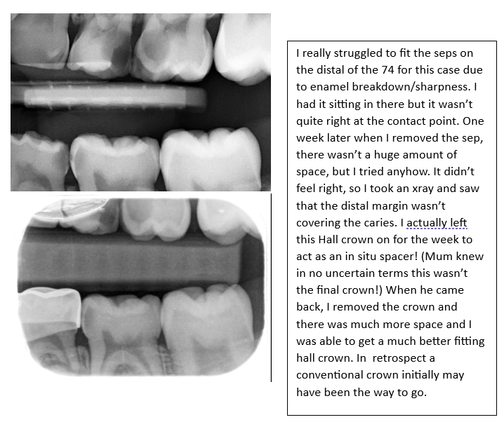 Troubleshooting Hall Crowns — Kids Dental Tips