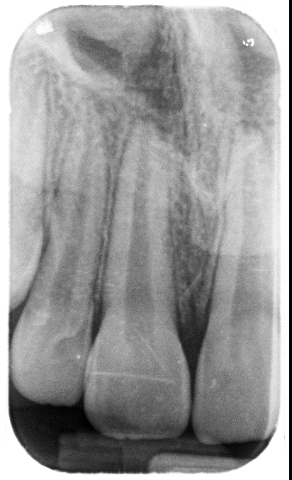 How to Reposition a Luxated (Displaced) Permanent Tooth — Kids Dental Tips