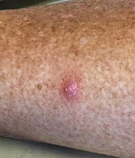 Early Squamous Cell Carcinoma